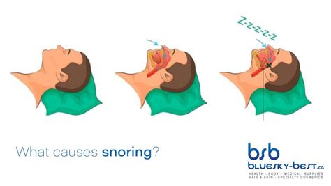 How To Stop Snoring A Complete Guideline Bluesky Best