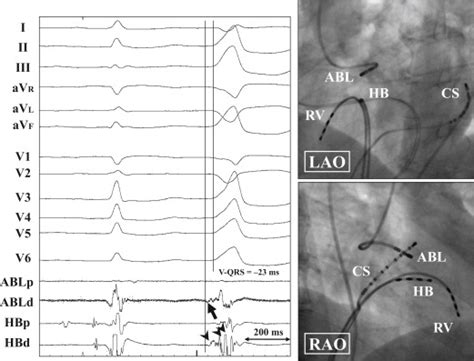 Techniques For Catheter Ablation Of Idiopathic Ventricular Arrhythmias