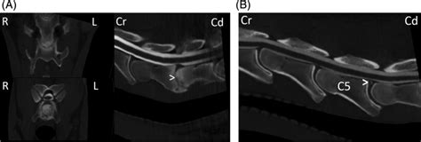A Computed Tomographic Ct Myelographic 3d Multiplanar Reconstruction