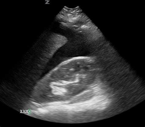 Gynecology Pelvic Ultrasound Made Easy Step By Step Guide Artofit