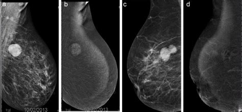 Contrast Enhanced Spectral Mammography Impact Of The Qualitative