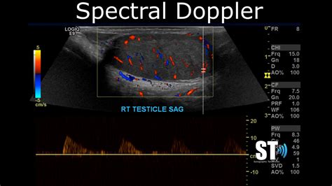 Testicular Scrotal Doppler Protocol Sonographic Tendencies