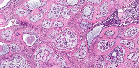 Pathology Outlines Sex Cord Tumor With Annular Tubules