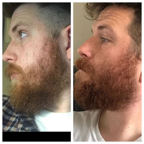 Patchy Beard Success Stories Before And After Photos Page 49 Beard