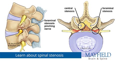 Spinal Stenosis Diagnosis And Treatments Mayfield Brain And Spine
