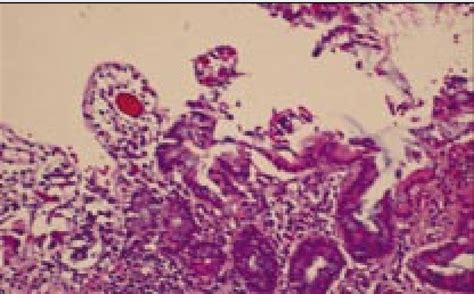 Histopathology Of The Resected Part Of Ileum Showed Infarction
