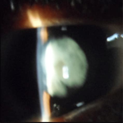 Case 2 Cortical And Nuclear Cataract Download Scientific Diagram