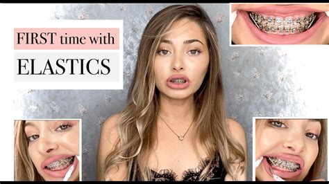 First Time With Elastics On Braces Youtube