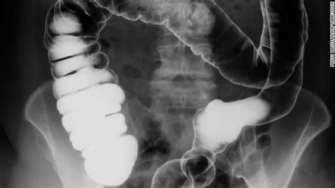 coming clean about my first colonoscopy