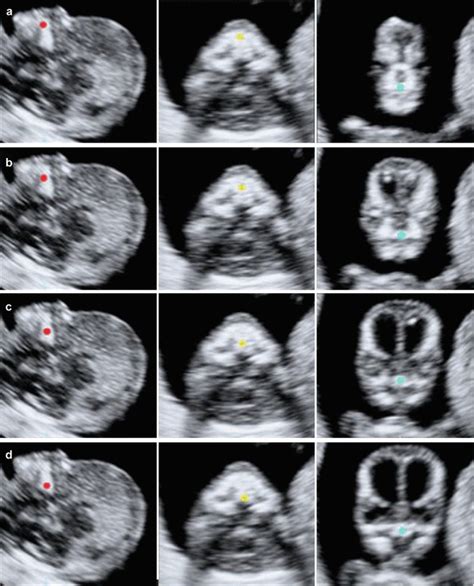 Evaluation Of The Fetal Face In The First Trimester Radiology Key
