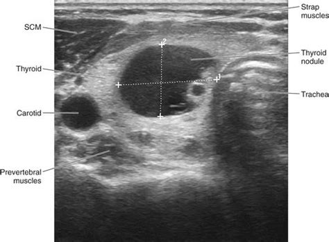 Neck Anatomy Ultrasound