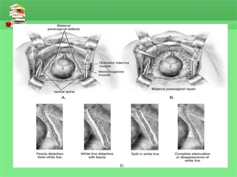 Uterine Prolapse Management