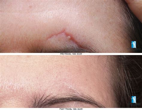 Scar Revision Cosmetic Elegance