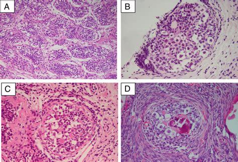 Histological Examination Of Gonadoblastoma A Normal Testicular Tissue