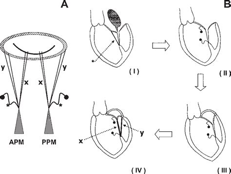 Figure 1 From New Surgical Procedure For Ischemic Functional Mitral