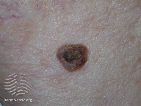 Seborrheic Keratosis Symptoms Causes Diagnosis And Treatment