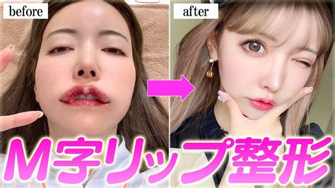 【整形】ダウンタイムも公開！双子モデルがまた整形してきました！ Youtube