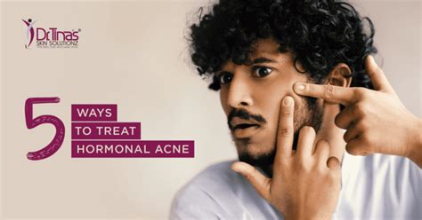 5 Ways To Treat Hormonal Acne Skin Solutionz