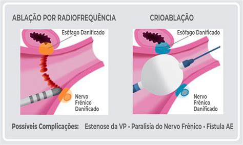 Farapulse™ Sistema De Ablação Por Campo Pulsado Boston Scientific