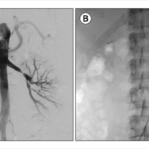 Conventional Angiogram Of Renal Artery Demonstrates Bilateral Renal