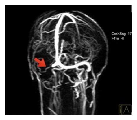 Mri Venography Showing Right Transverse And Sigmoid Sinus Thrombosis