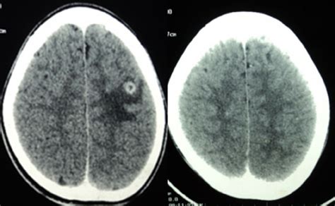 Computed Tomography Showing A Single Cerebral Parenchymal Calcification