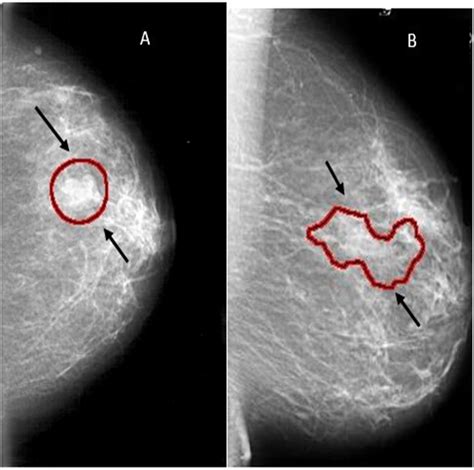 Breast Cancer Detection Using Machine Learning By Akhilesh Kumar Medium