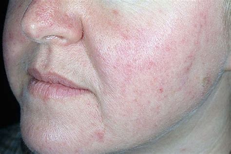 12 Easy And Effective Remedies To Get Rid Of Redness Of Face Naturally