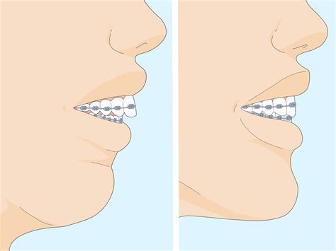 How To Fix Overbite Msapizza