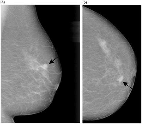 Granular Cell Tumor Of The Breast Mimicking Malignancy A Case Report