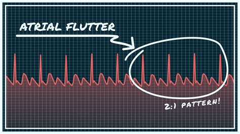 Atrial Fibrillation Vs Atrial Flutter Ecg
