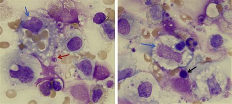 Diagnostic Challenges Of Hemophagocytic Lymphohistiocytosis Clinical