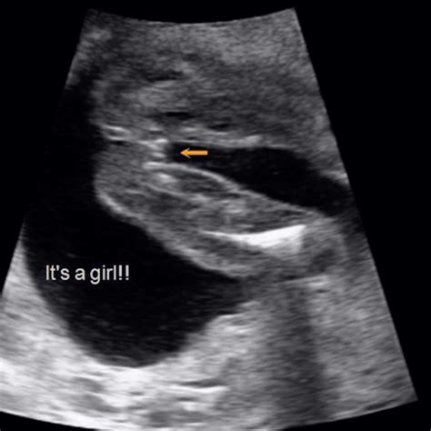 Early Gender Girls 15 Weeks 3d 4d 5d Hd Ultrasound Michigan