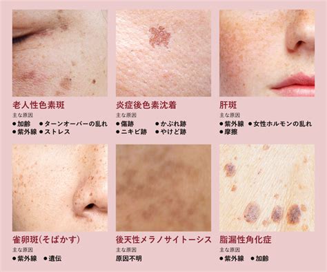 顔にできてしまったシミを対策する方法｜メカニズムを理解してシミを改善しよう シミ・コンシェルジュ