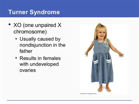 Turner Syndrome Xo Chromosome Maeteroch