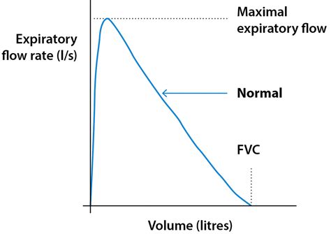 Spirometry Obstructive Pattern