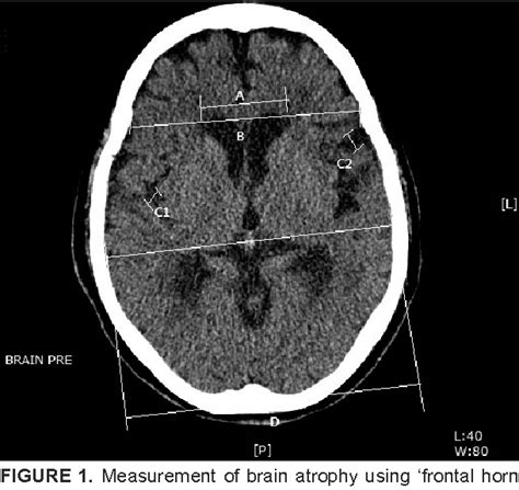 Figure 1 From Risk Factors Of Chronic Subdural Hematoma Progression