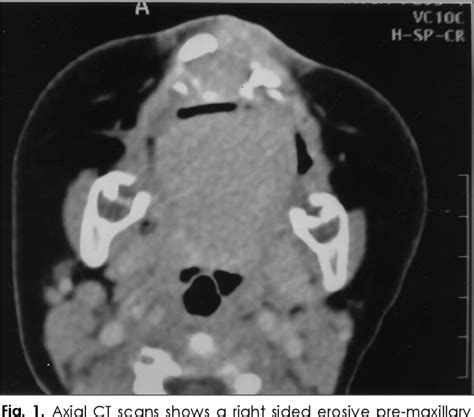Figure 1 From A Case Of Melanotic Neuroectodermal Tumor Of Infancy
