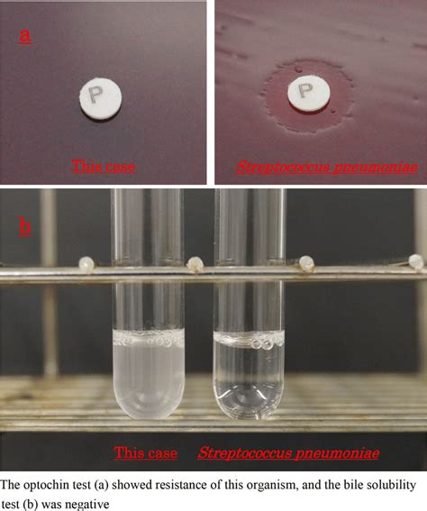 The Optochin Test And Bile Solubility Test Results For The Organism