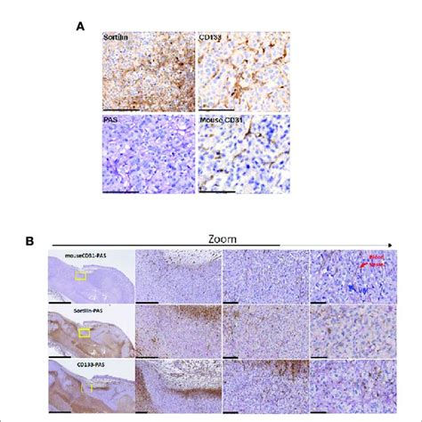Sort1 And Cd133 Expression In Es 2 Ovarian Tumor Xenografts Tumor