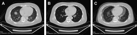 Attenuation Correction Strategies For Positron Emission Tomography