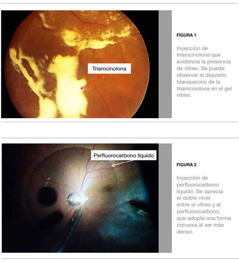 Tratamiento Del Desprendimiento De Retina Traccional Y Del Glaucoma