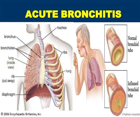 Bronchitis – Symptoms And Treatment