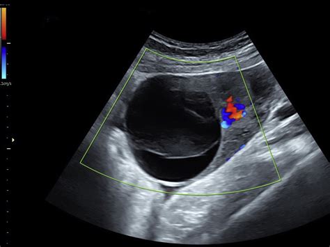 Gynecologic Ultrasound Evaluation Of The Nongravid Woman With Pelvic