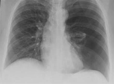 chest x ray showing large left pneumothorax with collap open i