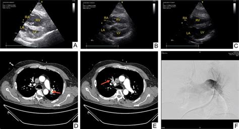 Bedside Ultrasound Evaluation Of Pulmonary Embolism And Thoracic Ct