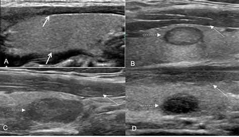 Stratifying Hypoechogenicity Into 3 Degrees Improves Ultrasound Thyroid