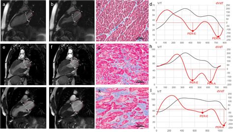 Frontiers Sex Differences In Atrial Remodeling And Its Relationship