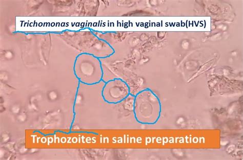 Trichomonas Vaginalis In High Vaginal Swab Hvs And Its Details