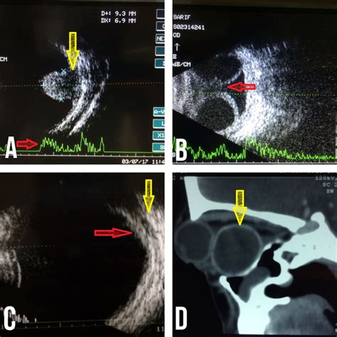 Ultrasound B Scan A Simple Tool To Simplify The Diagnosis Bmj Case